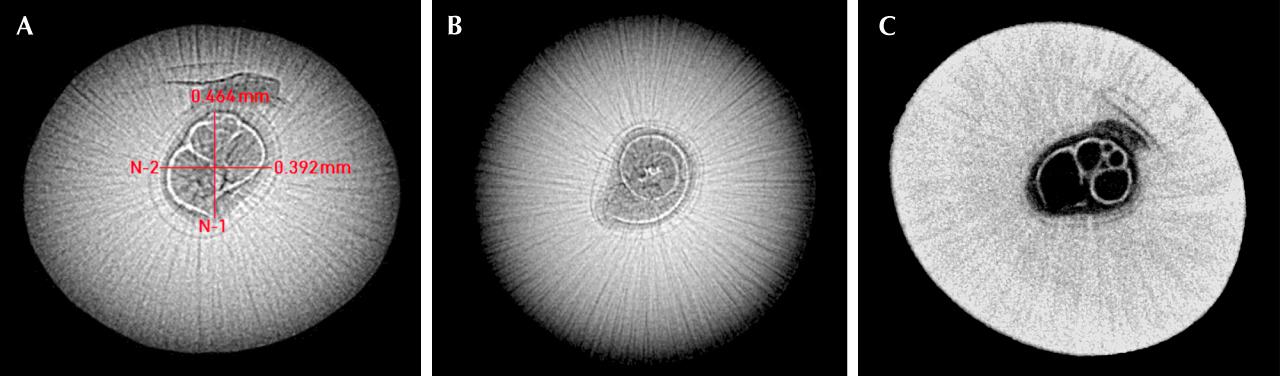A Minute Foraminifera Shell in a Natural Non-Nacreous Black Pearl